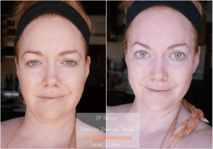 ZIIP Beauty Device Review | Before + After Photos of My Results ( + New ...