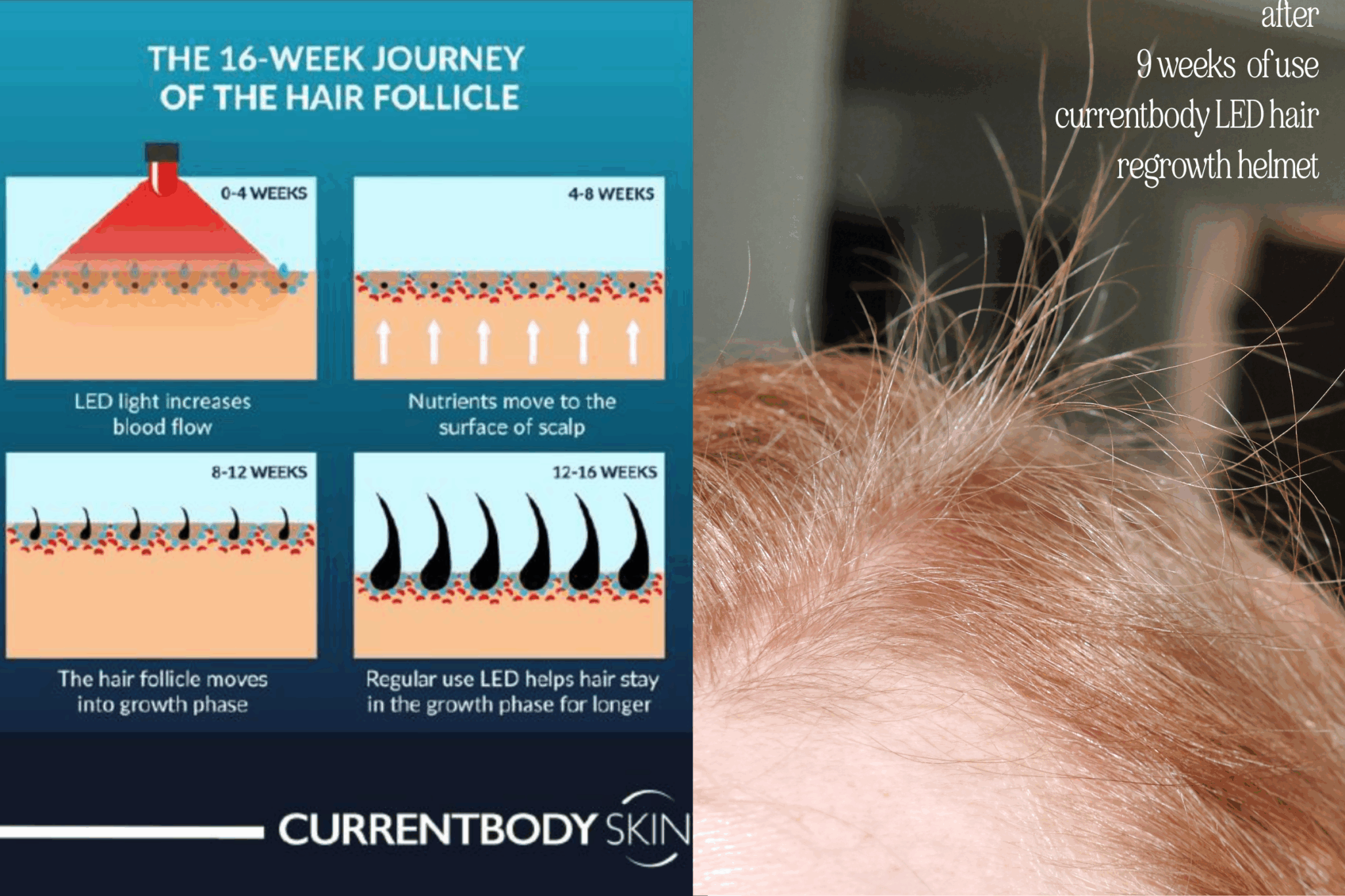 Currentbody Skin LED Red Light Hair Regrowth Helmet Review ...