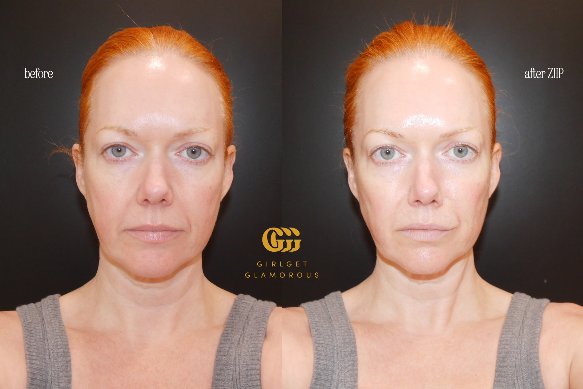 ZIIP HALO 2.0 Review + Discount Code | Best Skincare Tool for Immediate ...